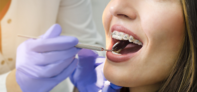 What To Expect When Getting Braces South East Orthodontics