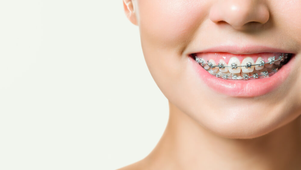 A Brief History of Braces | South East Orthodontics Berwick and Glen ...