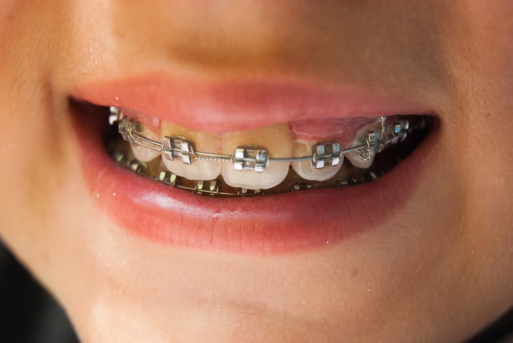 What to Do When a Bracket Comes Loose | Quick Fixes